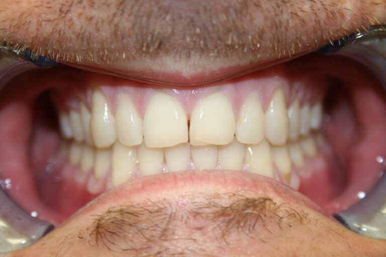 Extrinsic vs. Intrinsic Tooth Stains | Dr. Q Dental